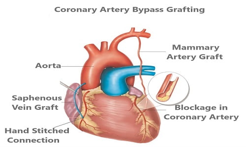 Coronary Artery Bypass Grafting (CABG) Surgery Cost in India