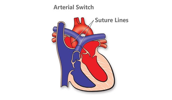 Arterial Switch Surgery
