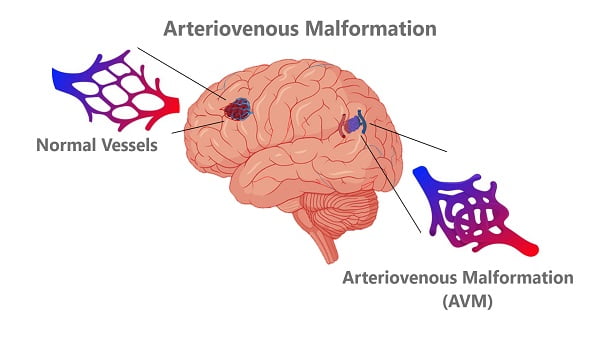 Arteriovenous Malformation Avm | تشوه شرياني وريدي
